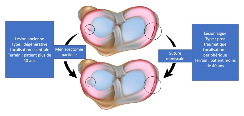 Suture méniscale | Réparation d'une déchirure du ménisque | CPHG Paris