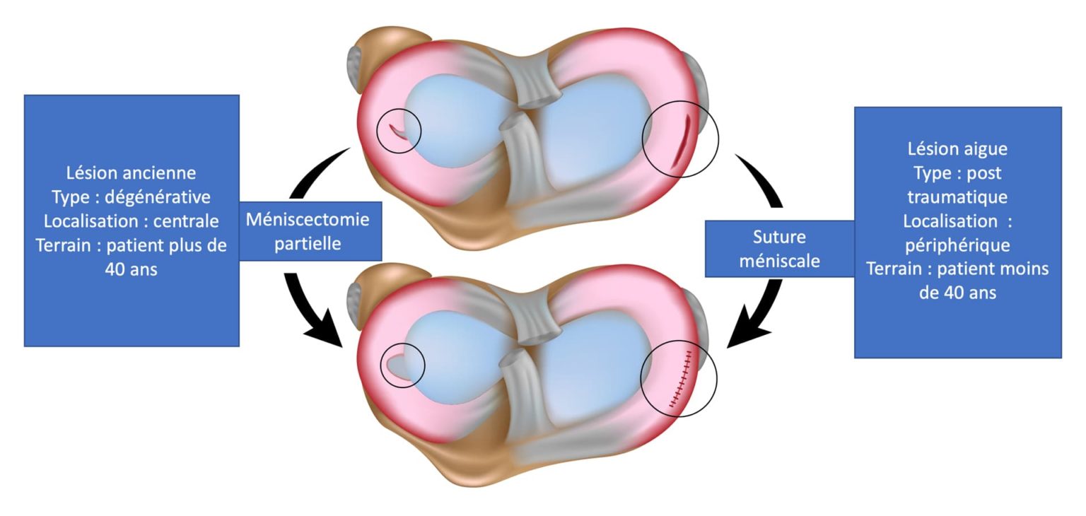 Suture méniscale | Réparation d'une déchirure du ménisque | CPHG Paris