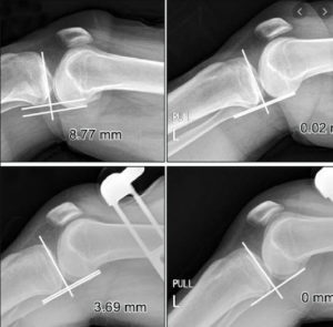 Rupture ligament croisé antérieur | Diagnostic et traitements | CPHG Paris