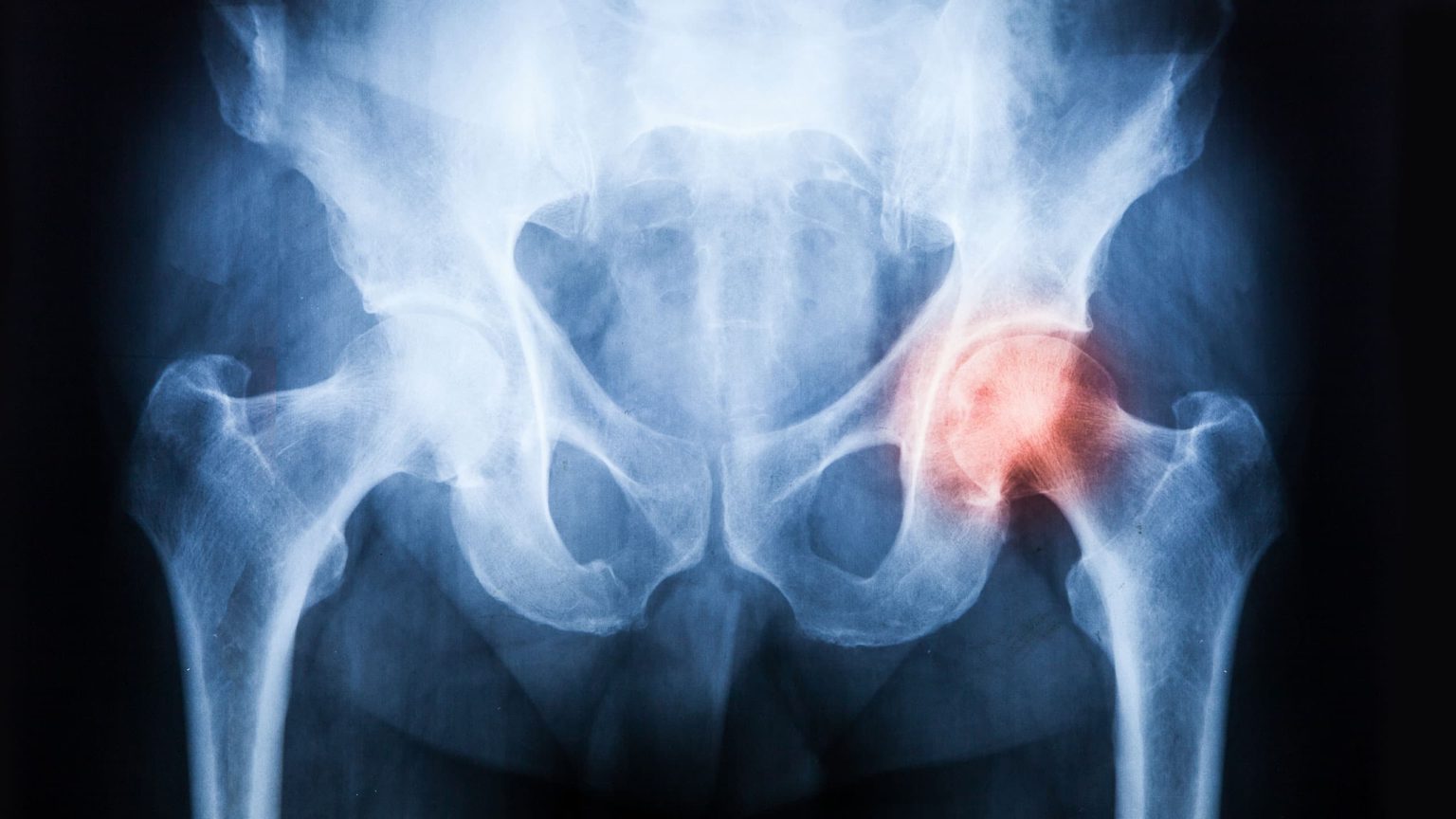 Anatomie de la hanche : os, muscles, moyens d'union, nerfs, vascularisation