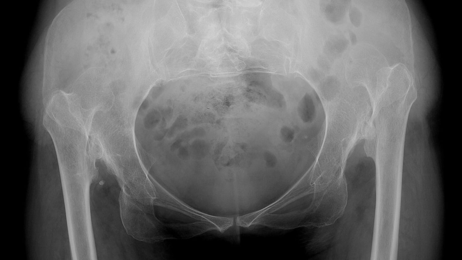 Fracture de hanche | Types de fractures et traitements | CPHG Paris